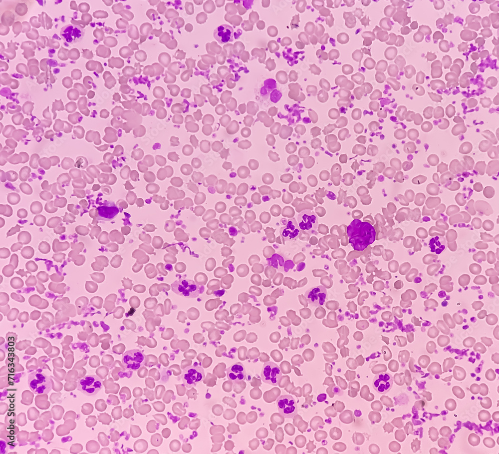 Essential thrombocytosis blood smear showing abnormal high volume of ...