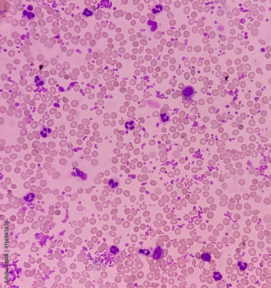 Essential thrombocytosis blood smear showing abnormal high volume of ...