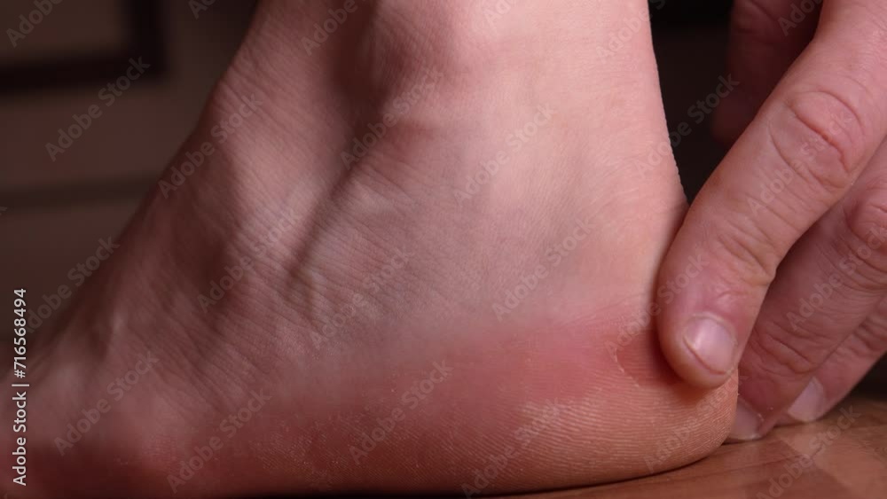 Calluses and corns, men's feet, consequences wearing uncomfortable ...