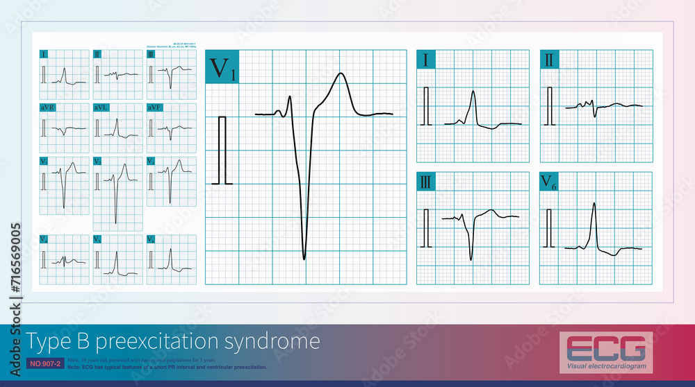 Male, 39 years old, presented with paroxysmal palpitations for 5 years ...
