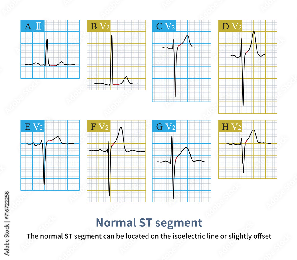The normal ST segment can be located on the isoelectric line or ...