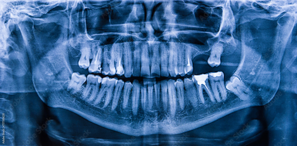 X-ray of the oral cavity with teeth. Orthopantomogram. Panoramic dental ...