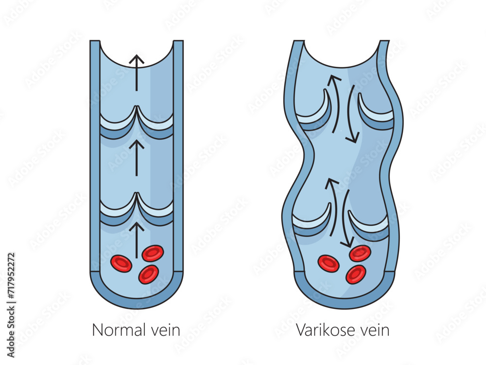 healthy and varicose veins structure diagram hand drawn schematic ...