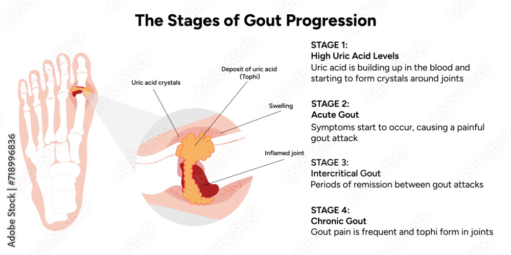 Medical Information And Infographic On The Stages Of Gout Progression