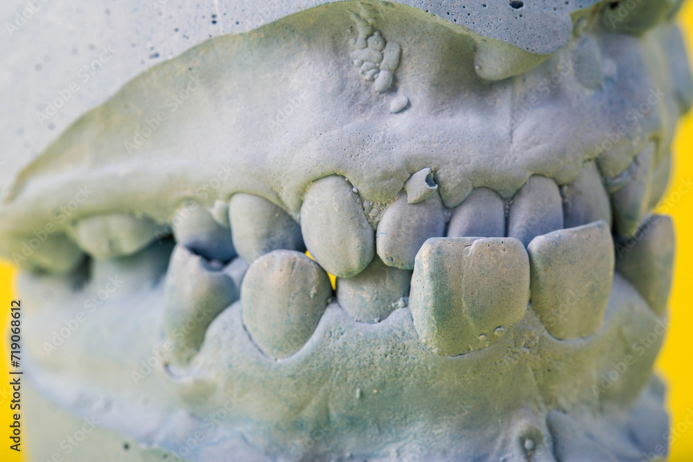 Blue plaster impression of the dental jaw of a patient with crooked ...