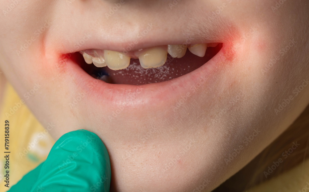 A doctor wearing medical gloves examines the mouth and lip jams of a ...