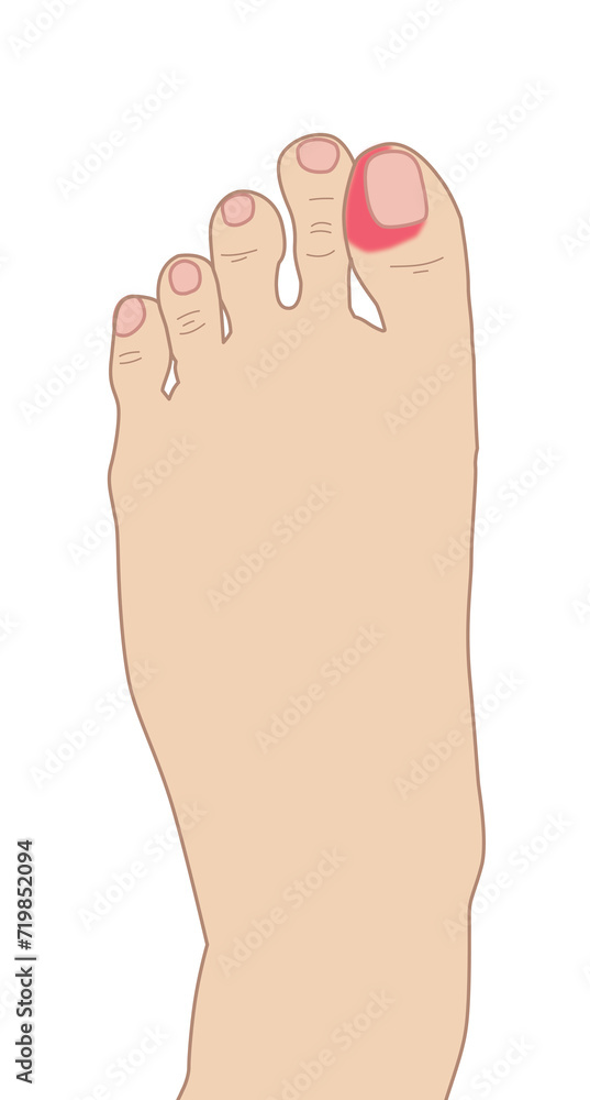 Ingrown toenail left foot, illustration on white background Stock ...