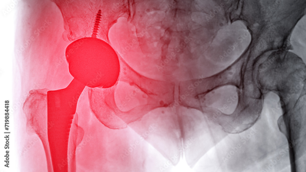 An X-ray reveals both hip joints with TOTAL HIP ARTHROPLASTY ...