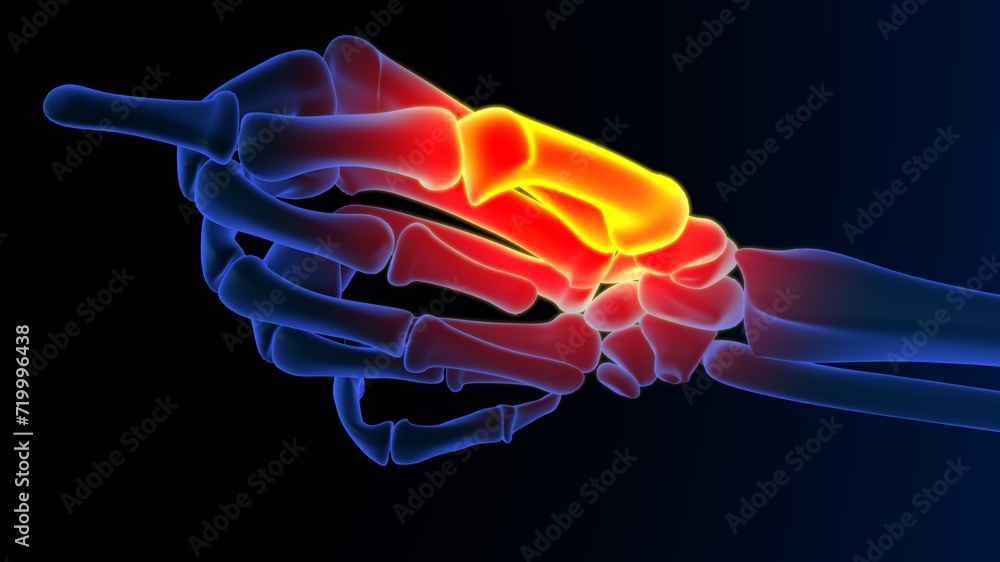 Thumb metacarpal bone pain anatomy for medical concept 3D rendering ...