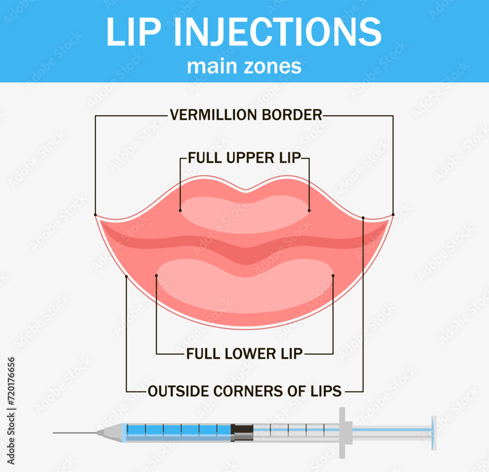 Lip injection hyaluronic acid filler. Hyaluronic acid lip injections ...