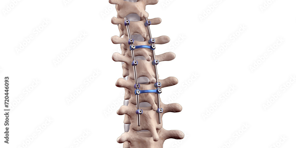Spine Posterior Thoracic Fusion with Pedicle Screws and Rods on White ...