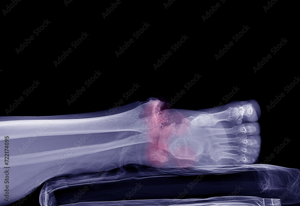 X-ray image of a severely broken ankle according to the doctor's ...