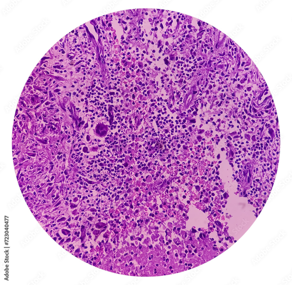 Cold abscess wall (biopsy). Chronic granulomatous inflammation (CGI ...