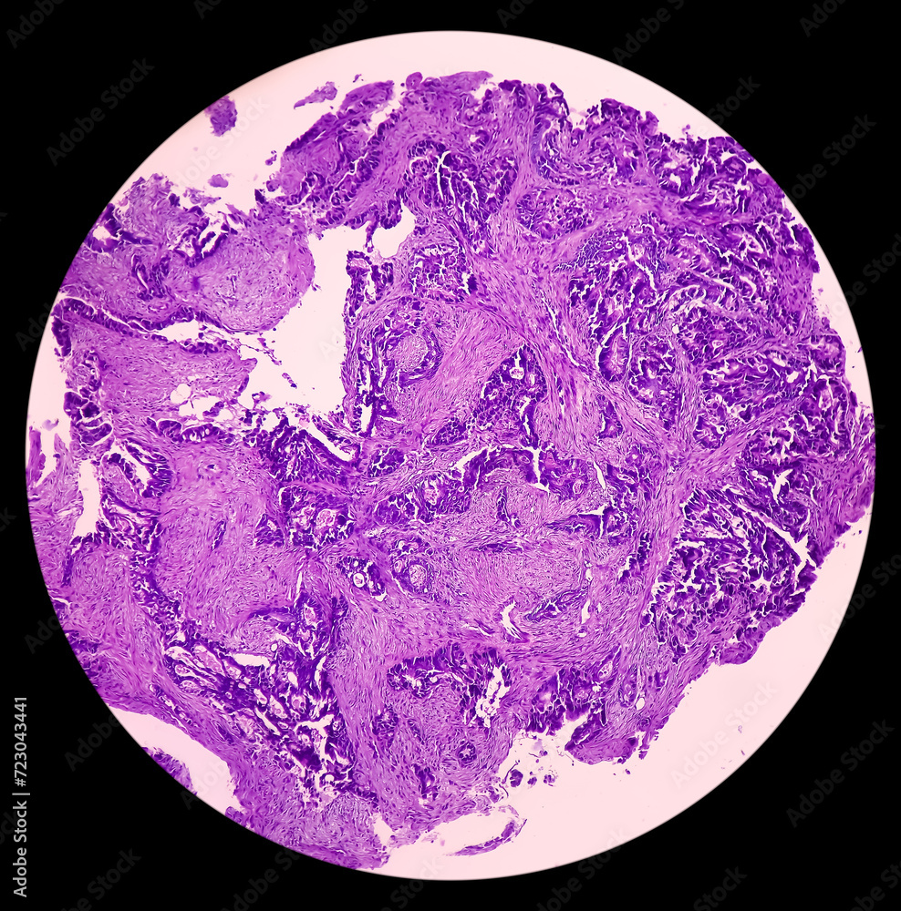 Rectal cancer. Rectum adenocarcinoma. IBD. IBS. Squamous cell carcinoma ...
