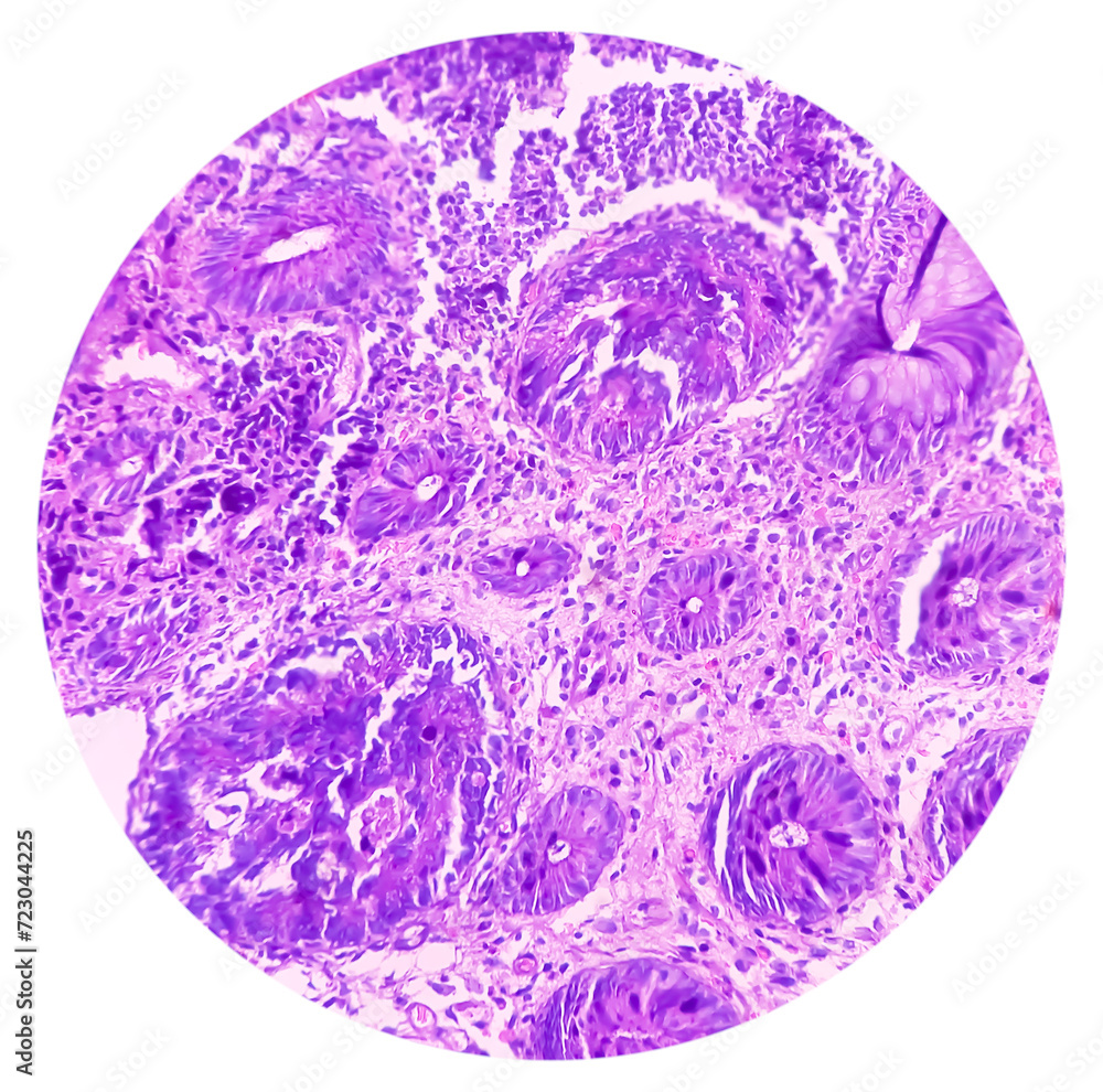 Rectal cancer. Rectum adenocarcinoma. IBD. IBS. Squamous cell carcinoma ...