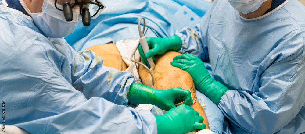 Process of varicose vein surgery in hospital, vein sealing, venous ...