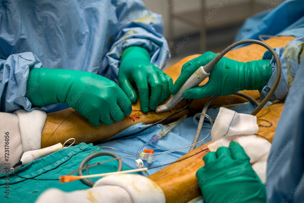 Process of varicose vein surgery in hospital, vein sealing, venous ...