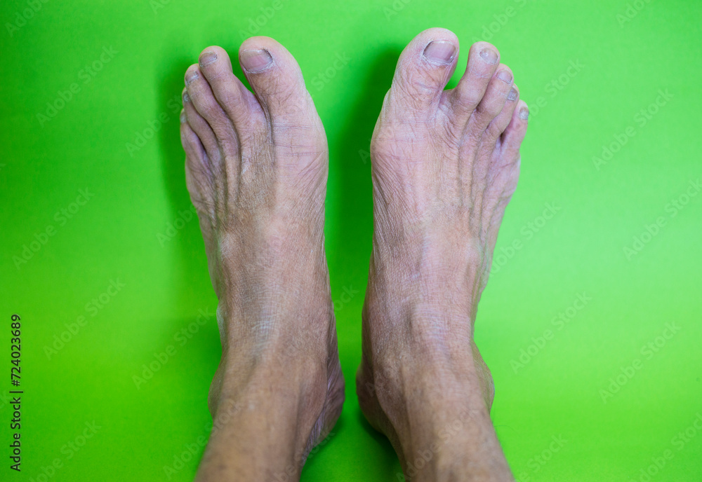 Wrinkles and dryness of the skin of the feet and other parts of the ...