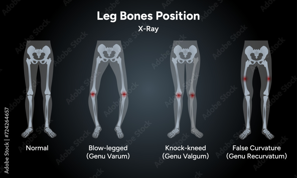 Leg bones position Blowlegged knock-kneed in x-ray Stock Vector | Adobe ...