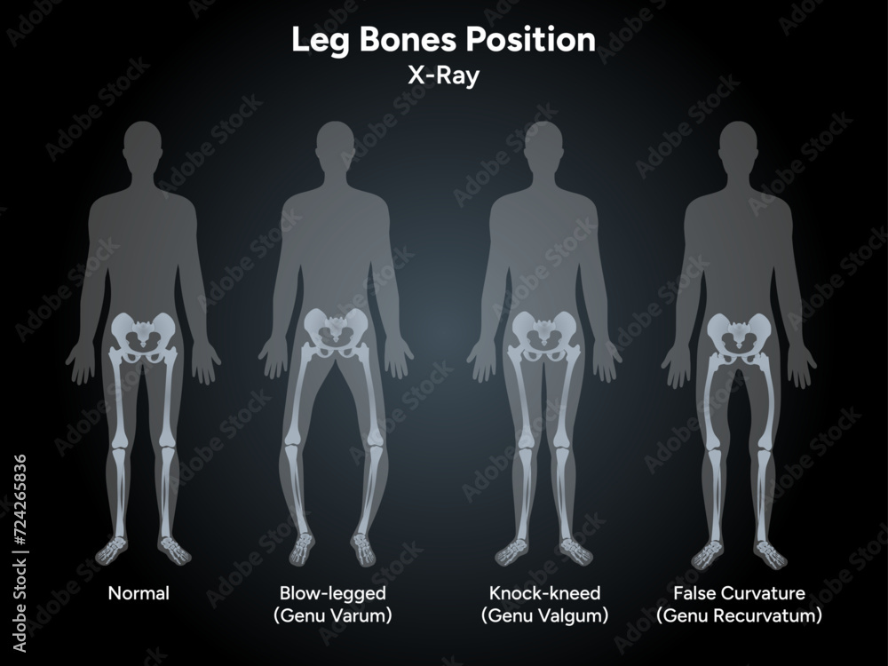 Leg bones position Blowlegged knock kneed face curvature in x-ray Stock ...