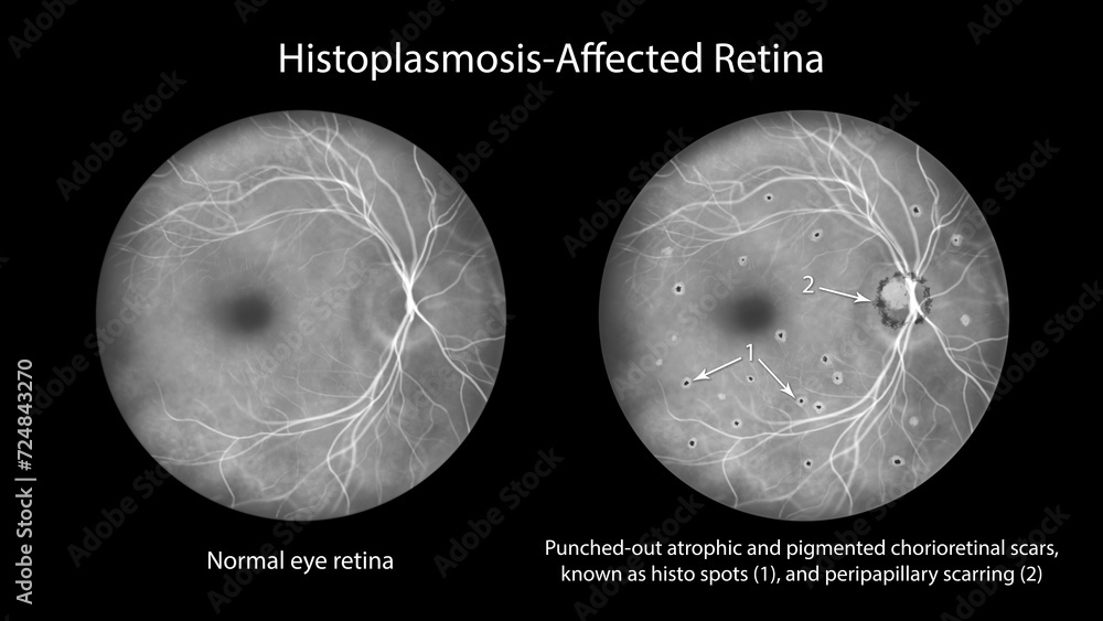 Retina in Ocular Histoplasmosis Syndrome, illustration Stock ...
