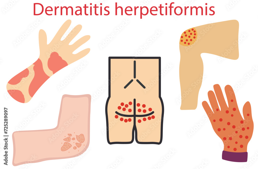 dermatitis herpetiformis,chemical exposure latex allergy the allergic itching,skin condition of ...