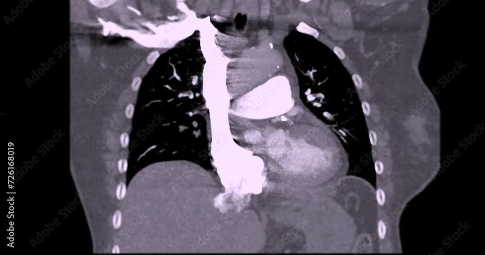 CTA pulmonary artery is a non-invasive imaging technique, providing ...