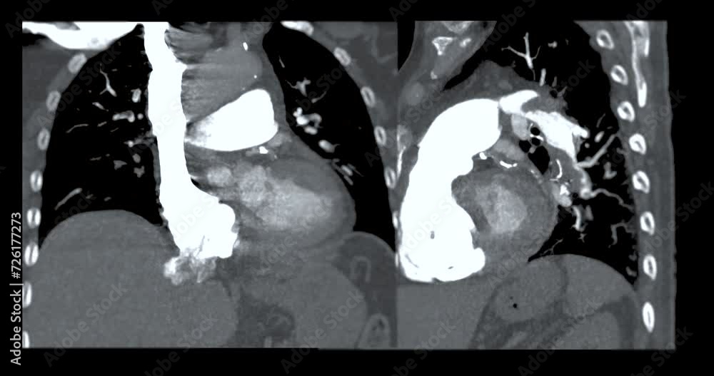 CTA pulmonary artery is a non-invasive imaging technique, providing ...