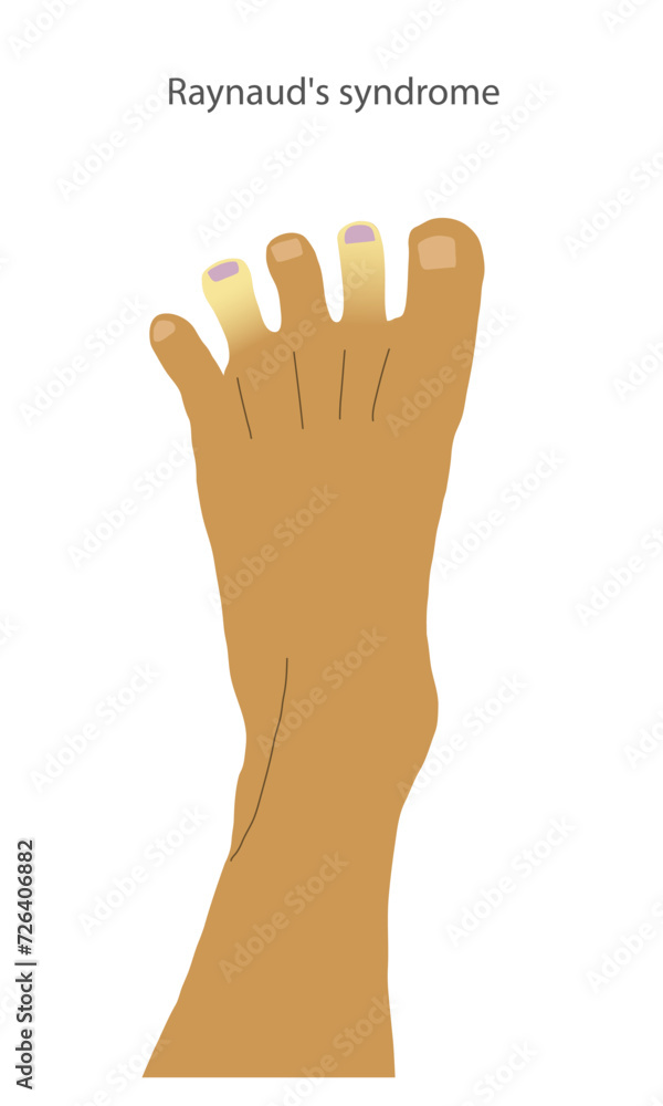 A foot with Raynaud's syndrome symptoms on tips of the toes. Peripheral ...
