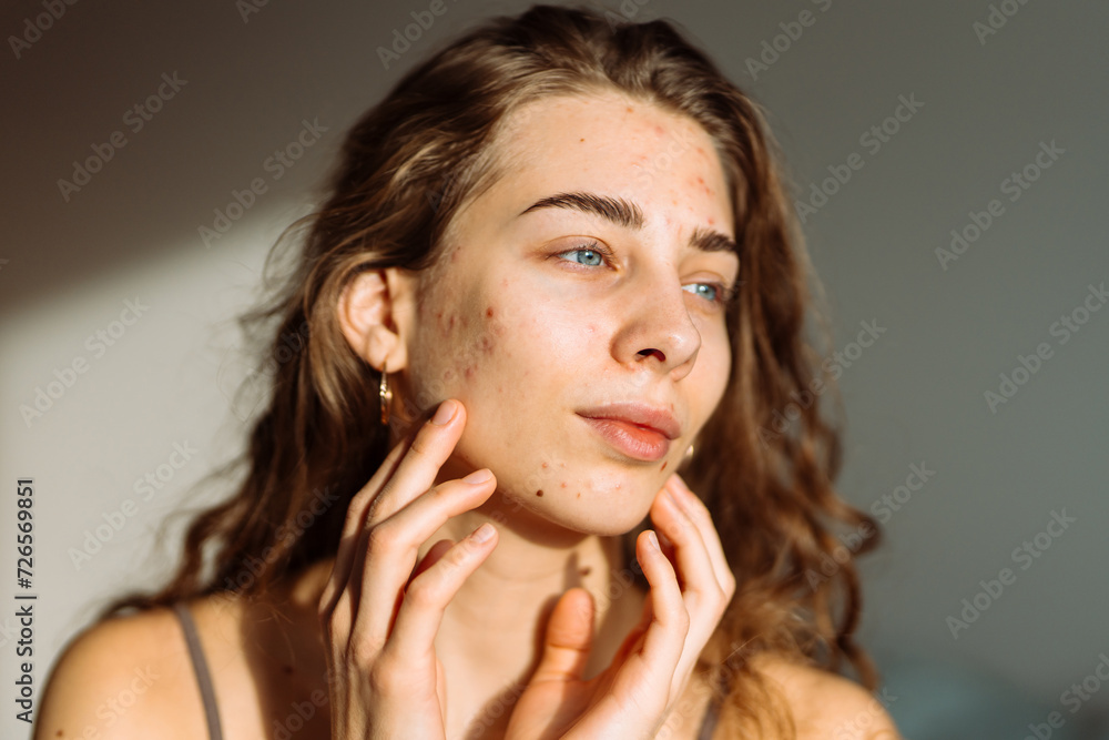 Young woman touching a pimple on her face, feeling annoyed because of ...