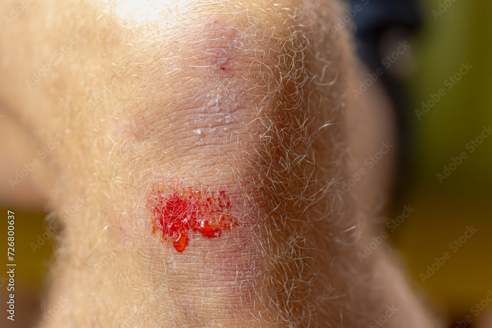 First aid and injuries concept, A man show his leg with little bit ...