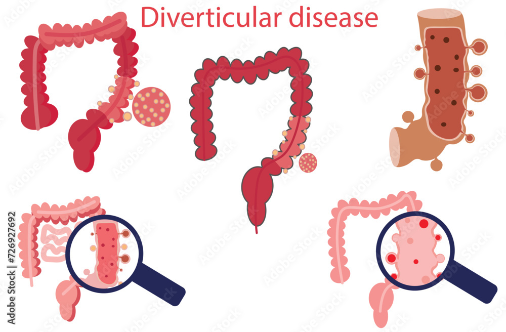 Diverticular disease and diverticulitis,affect the large intestine ...