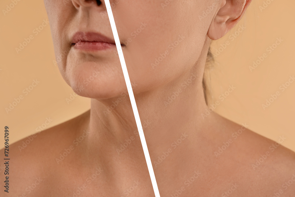Aging skin changes. Woman showing neck before and after rejuvenation ...