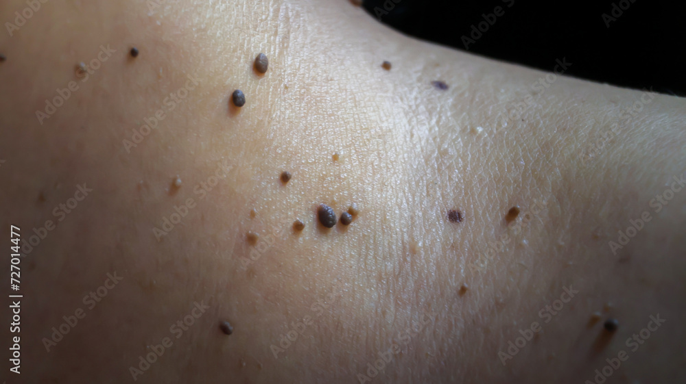 High-resolution close-up image showcasing skin tags, also known as ...
