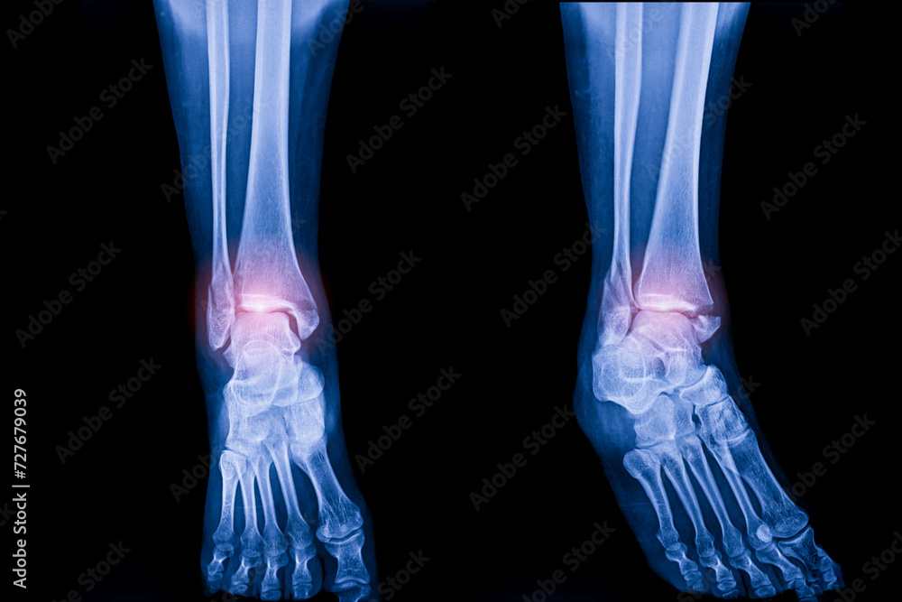 Ankle x ray after accident in orthopedic unit inside trauma hospital.X ...