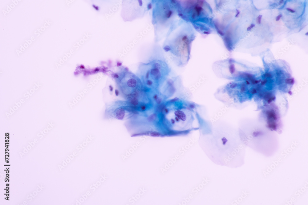 Abnormal squamous epithelial cells view in microscopy.Humanpapilloma ...