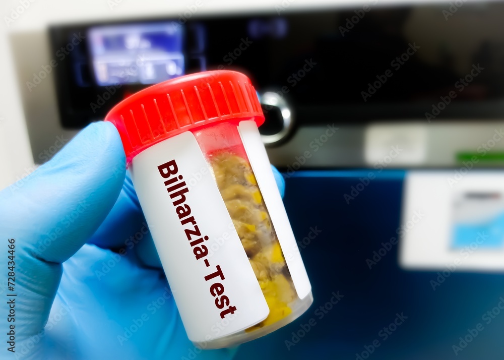 Schistosomiasis or Bilharzia, an infection caused by a parasitic worm ...