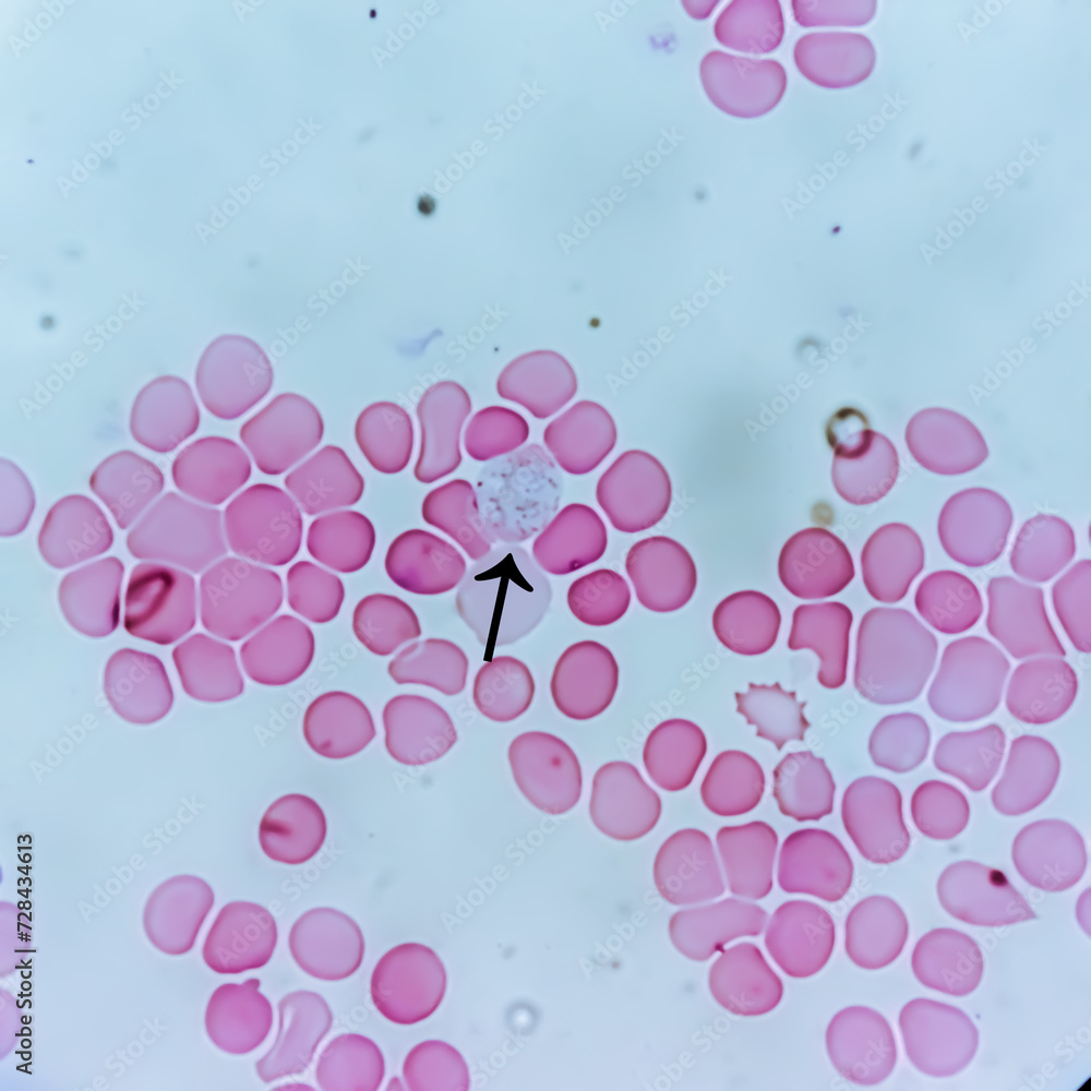 Plasmodium vivax in thin film under microscopy, Malaria disease. P. vivax, Malaria parasite in ...