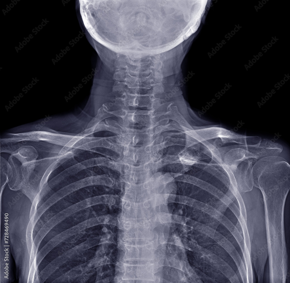 x-ray photo AP neck and thorax as directed by a physician Stock Photo ...