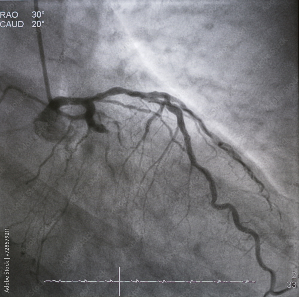 Coronary angiogram (CAG) was performed chronic total occlusion (CTO) at ...