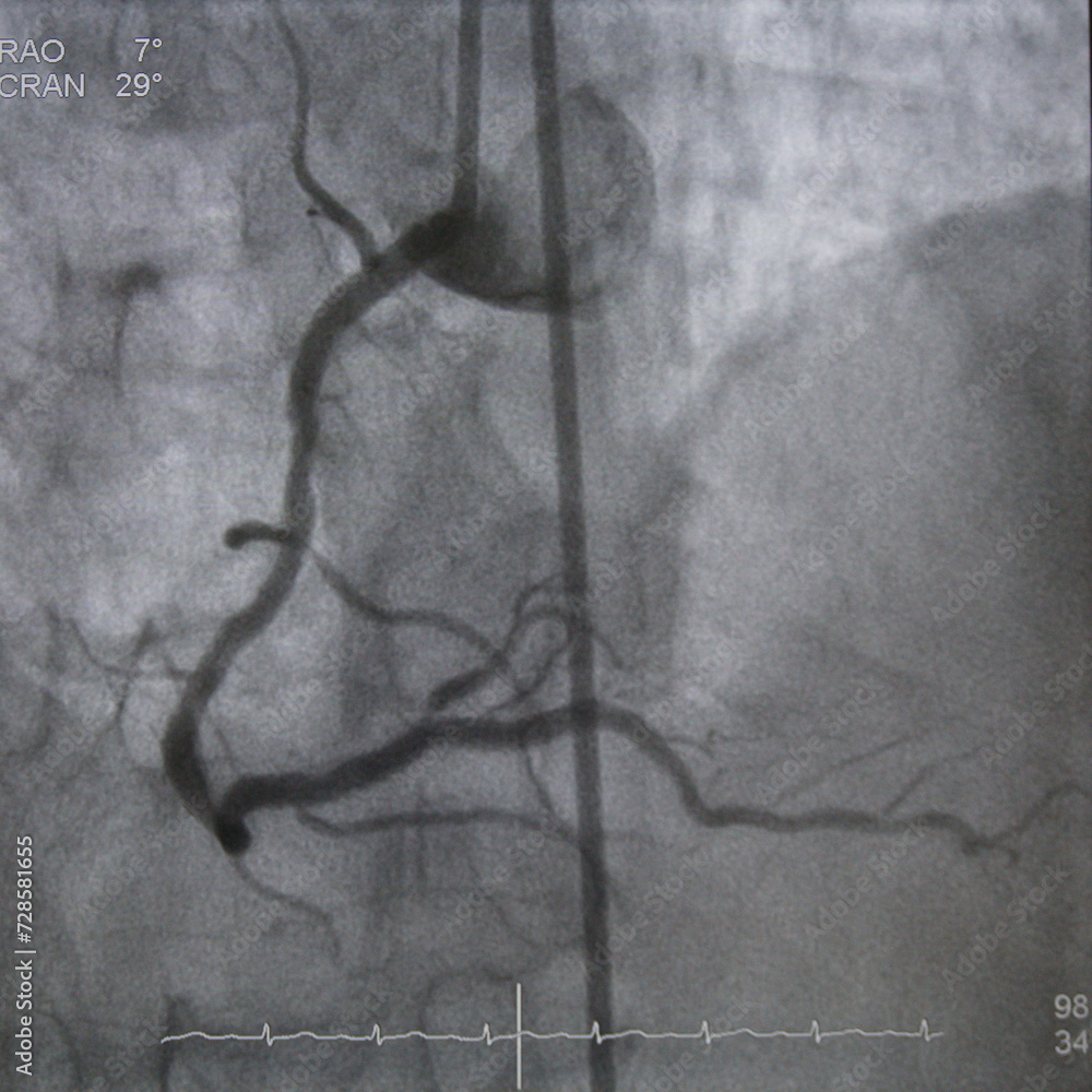 Coronary angiogram (CAG) was performed right coronary artery (RCA ...