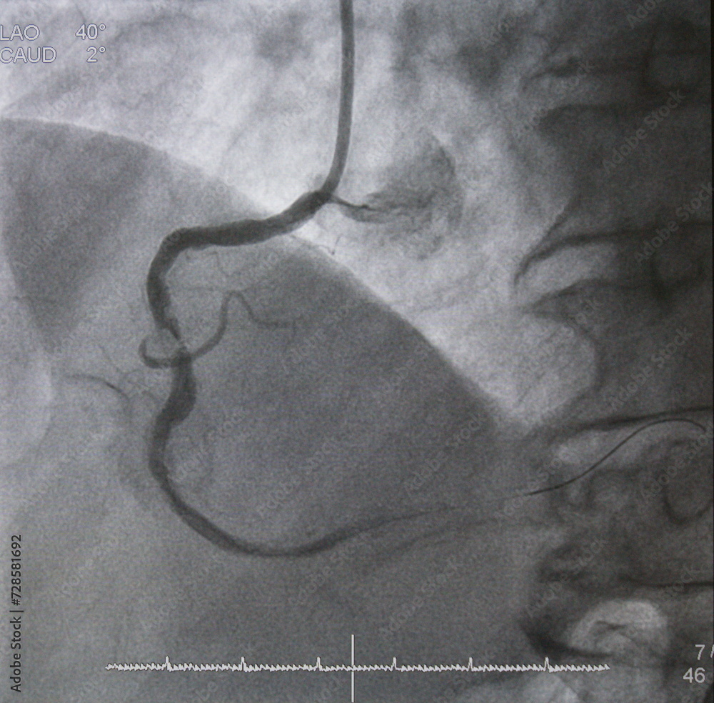 Foto de Coronary angiogram (CAG) was performed total occlusion at right ...