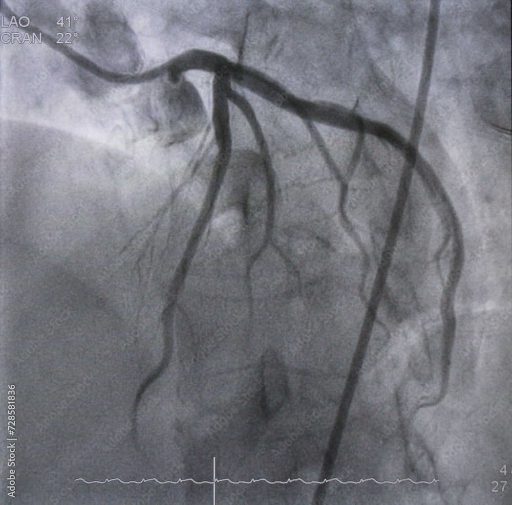 Coronary angiogram (CAG) was performed normal left coronary artery (LCA ...