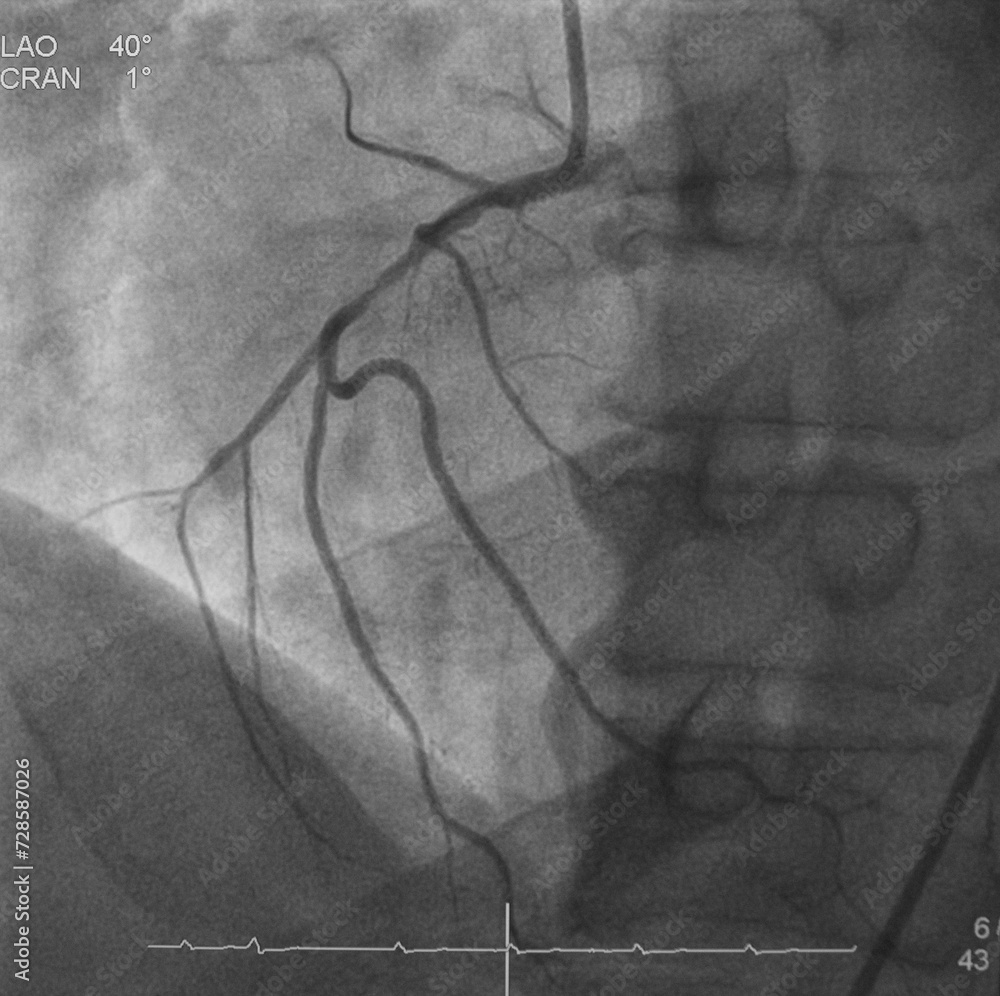 Coronary angiogram (CAG) was performed normal right coronary artery ...