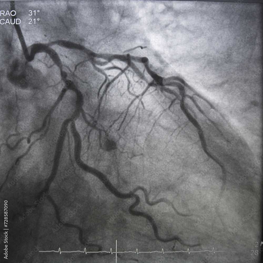 Coronary angiogram (CAG) was performed left coronary artery (LCA ...