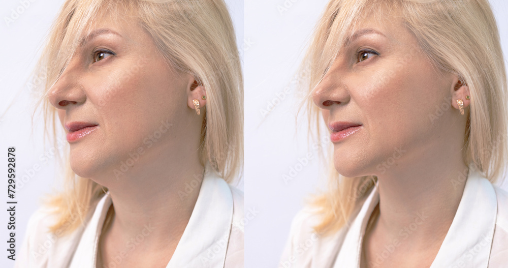 Female double chin before and after correction. Correction of the chin ...