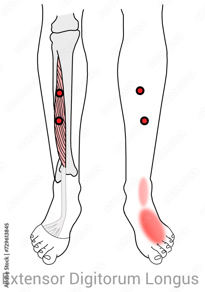 Extensor digitorum longus myofascial trigger points and associated pain ...