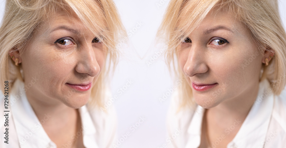 Female double chin before and after correction. Correction of the chin ...