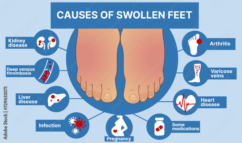 Causes of swollen feet. Healthcare infographic, educational ...