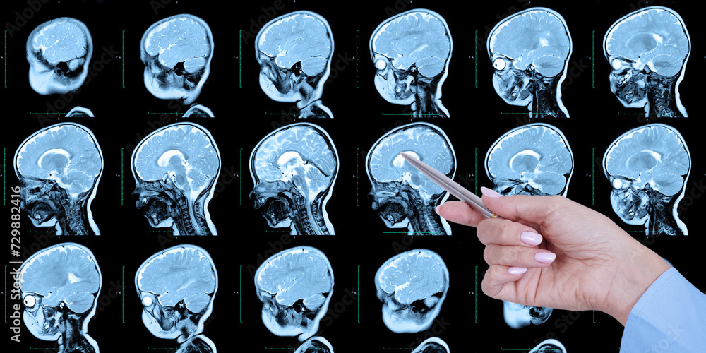 Doctor's hand points to a set of MRI scans of the human skull and brain ...